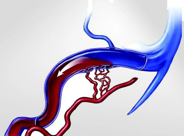 Dural Arteriovenous Fistula (DAF) Treatment - IBS Hospital